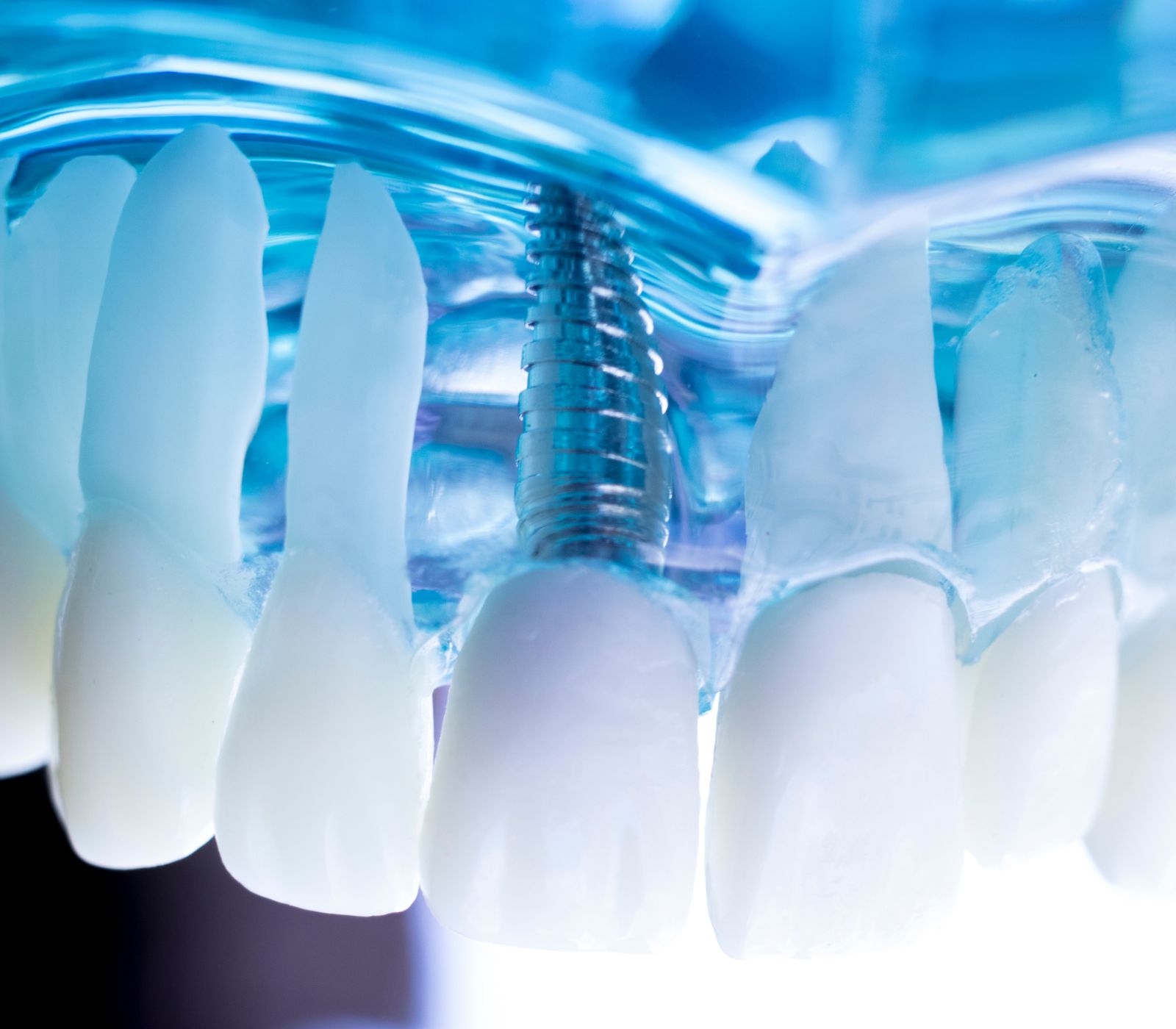 Maintenance Implantaire - Implantologie dentaire Limoges