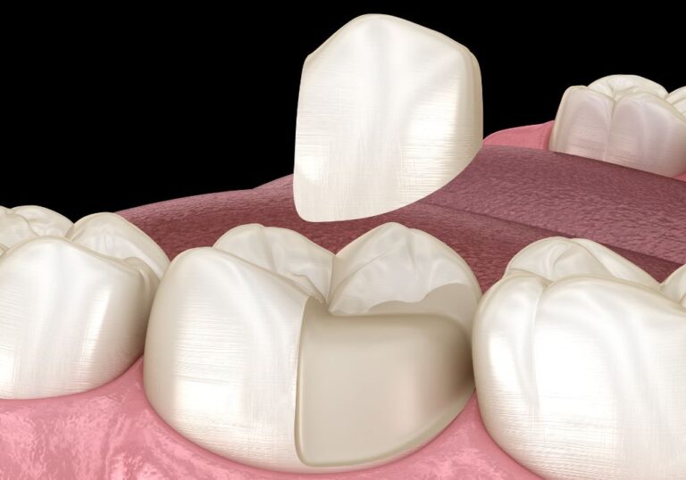 Inlays / Onlays Limoges - Cabinet dentaire - Dentiste Limoges