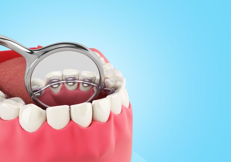 Orthodontie Linguale Limoges - Dentiste Limoges - Orthodontie 87